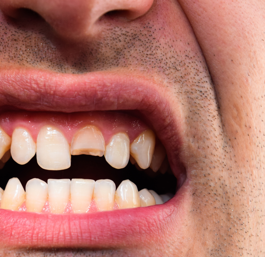 Tips and Solutions for Teeth Grinding/Clenching - NYCCD