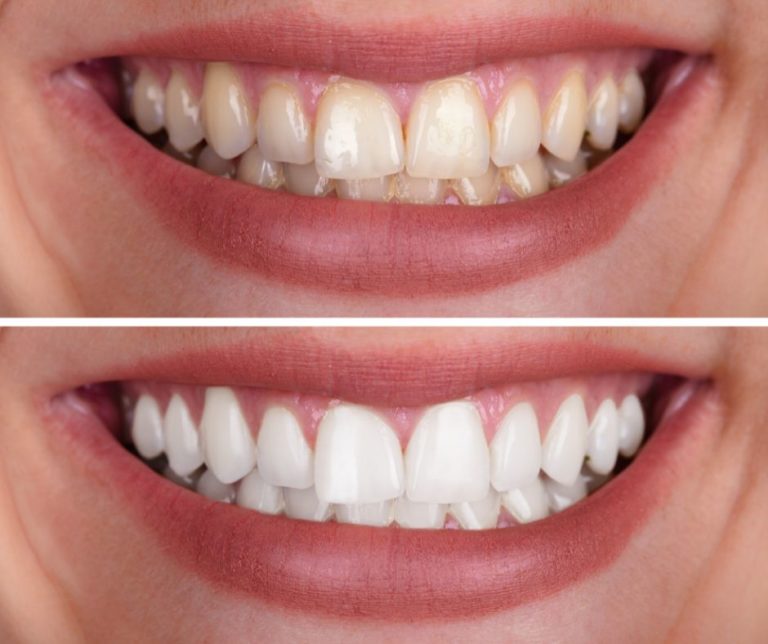 Why Your Teeth Look Yellow Even After Whitening – And How to Fix It | NYCCD